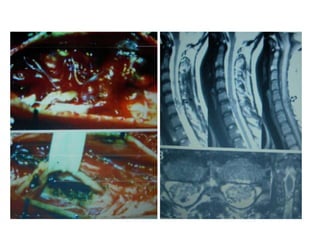 SPINAL AVM.pptx