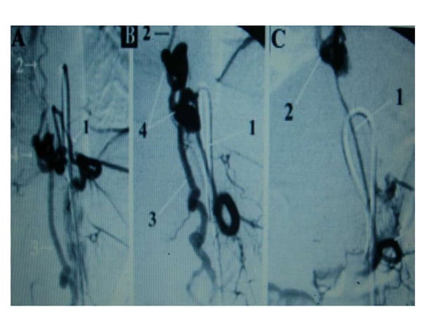 SPINAL AVM.pptx | Brain and Nervous System Disorders | Diseases and ...