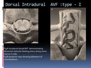 Spinal AVM AIIMS.pptx