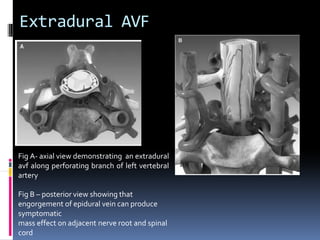 Spinal AVM AIIMS.pptx