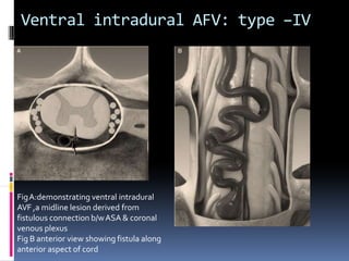 Spinal AVM AIIMS.pptx