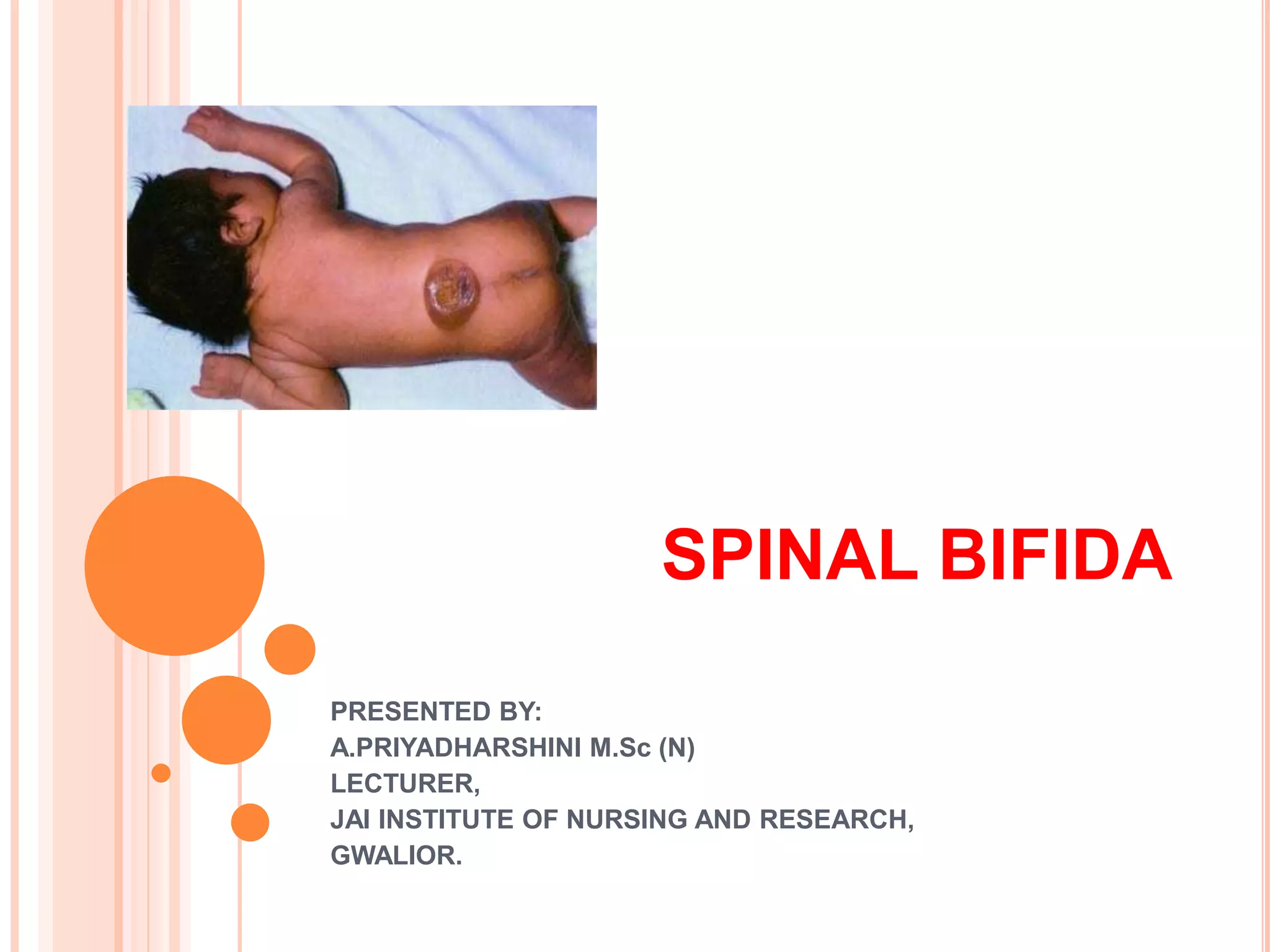 Spinal bifida | PPTX