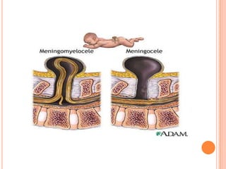 Spinal bifida | PPTX