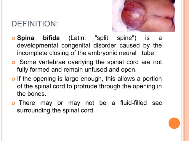 Spinal bifida | PPTX