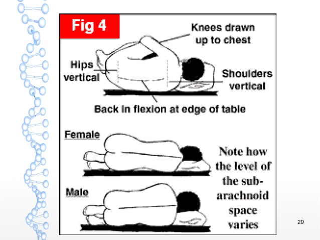 Central Neuroxial blockage ( Spinal and Epidural block ) By Dr Sachin ...