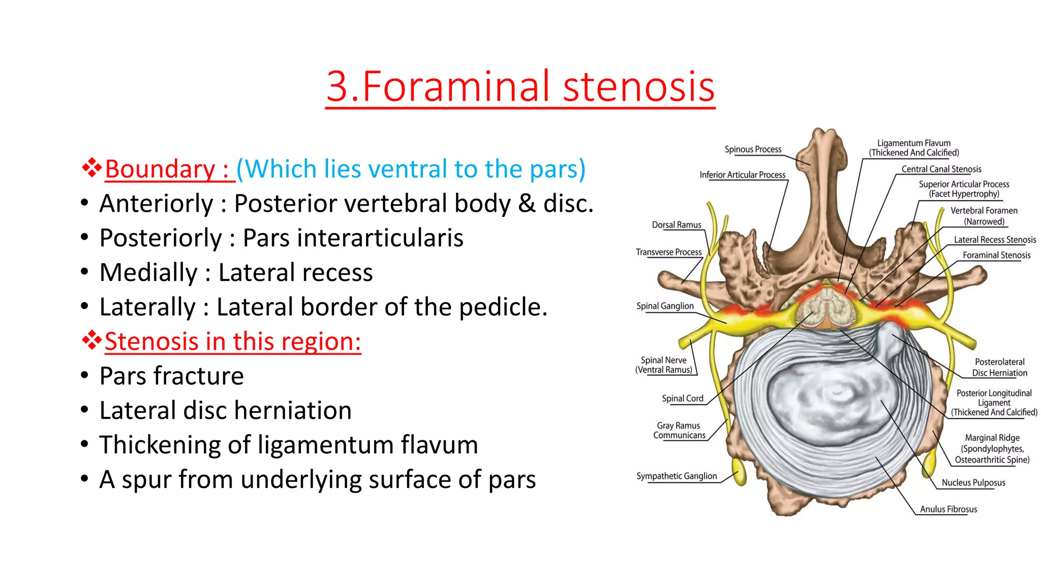 Spinal canal stenosis | PPTX