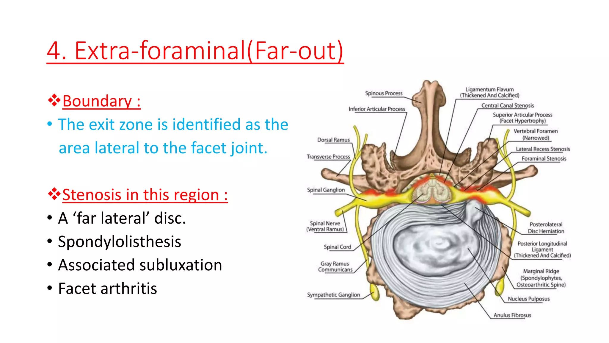 Spinal canal stenosis | PPTX