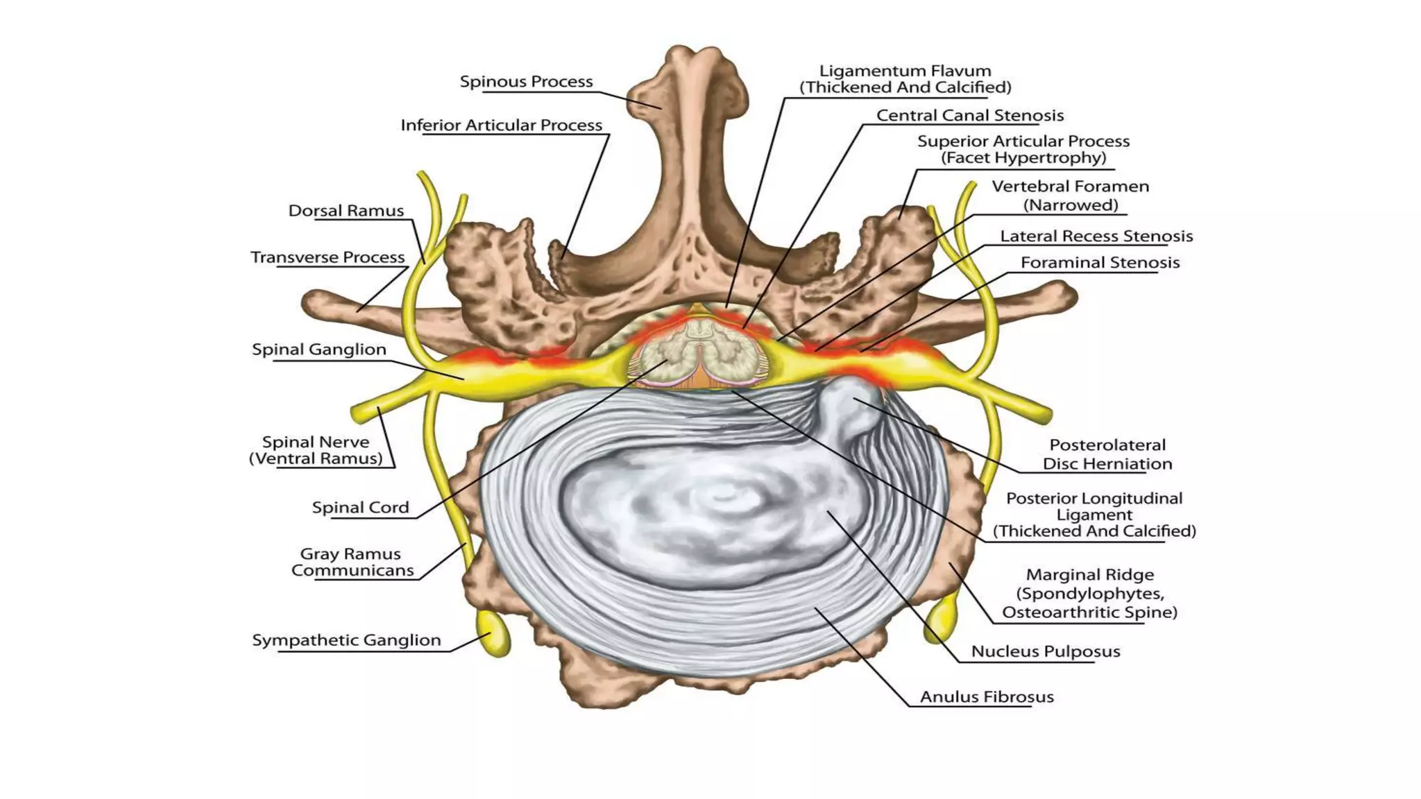 Spinal canal stenosis | PPTX