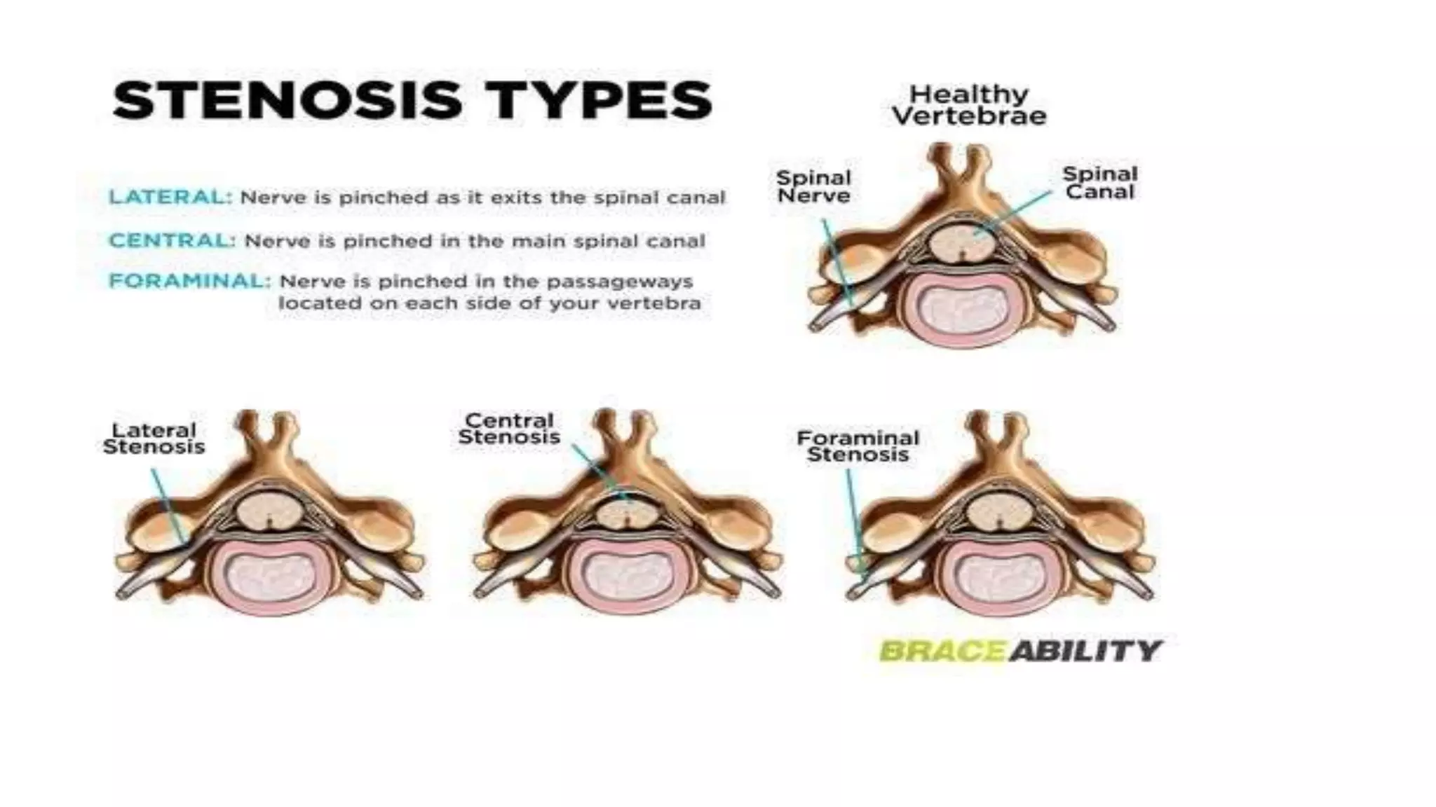 Spinal Canal Stenosis Ppt
