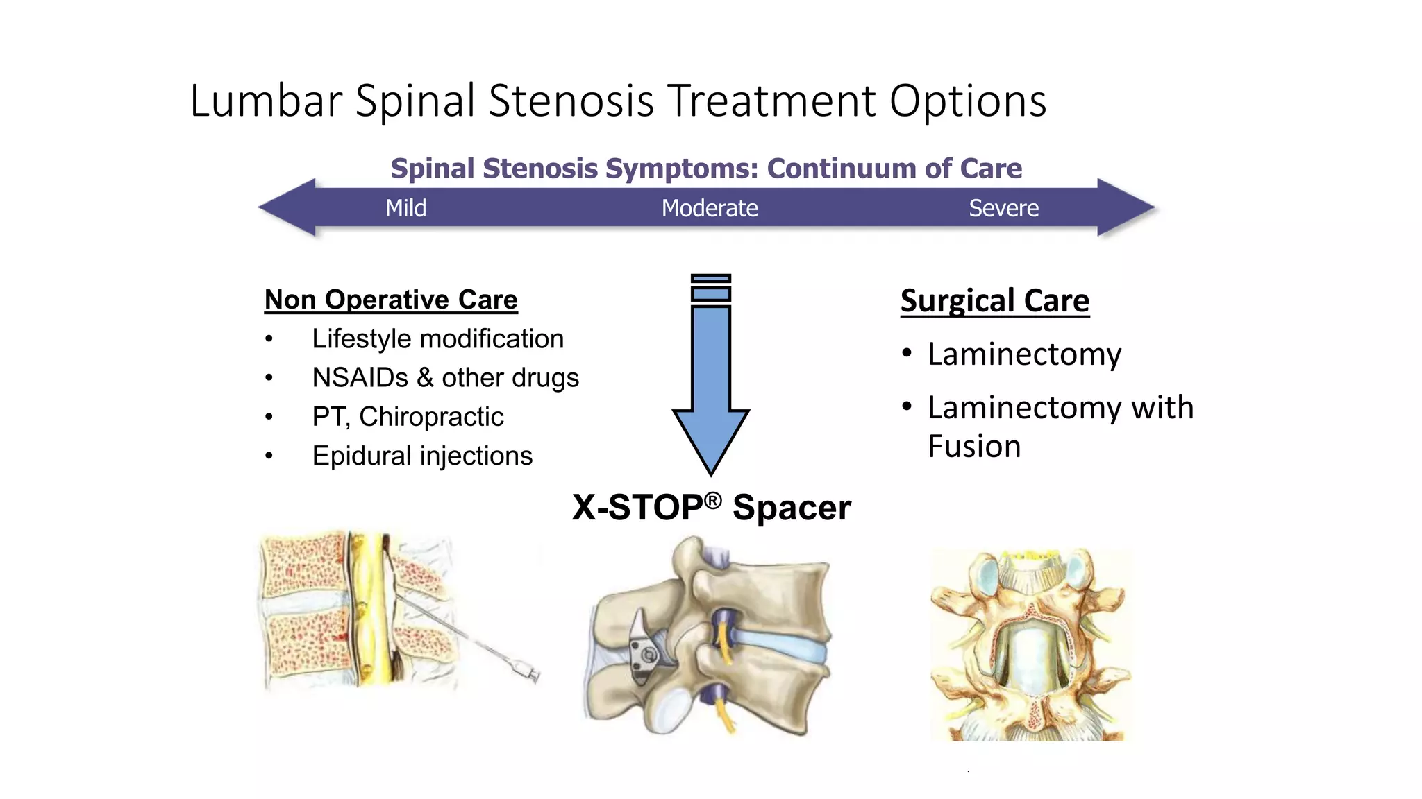 Spinal canal stenosis | PPTX