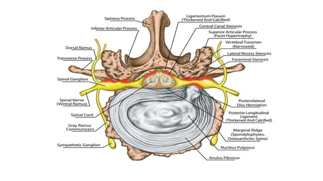 Spinal canal stenosis | PPTX | Physical Therapy | Wellness