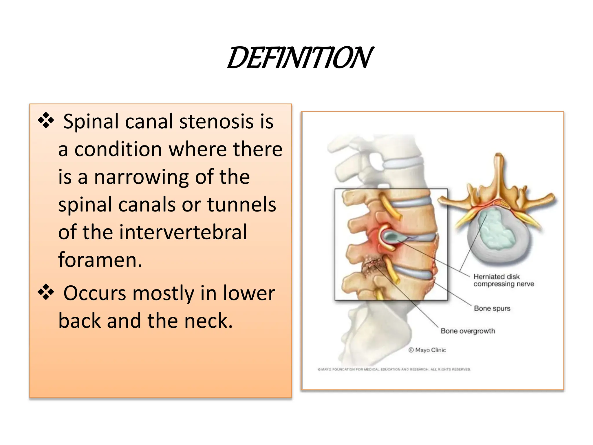spinal canal stenosis.pptx definition, classification, pathophysiology ...