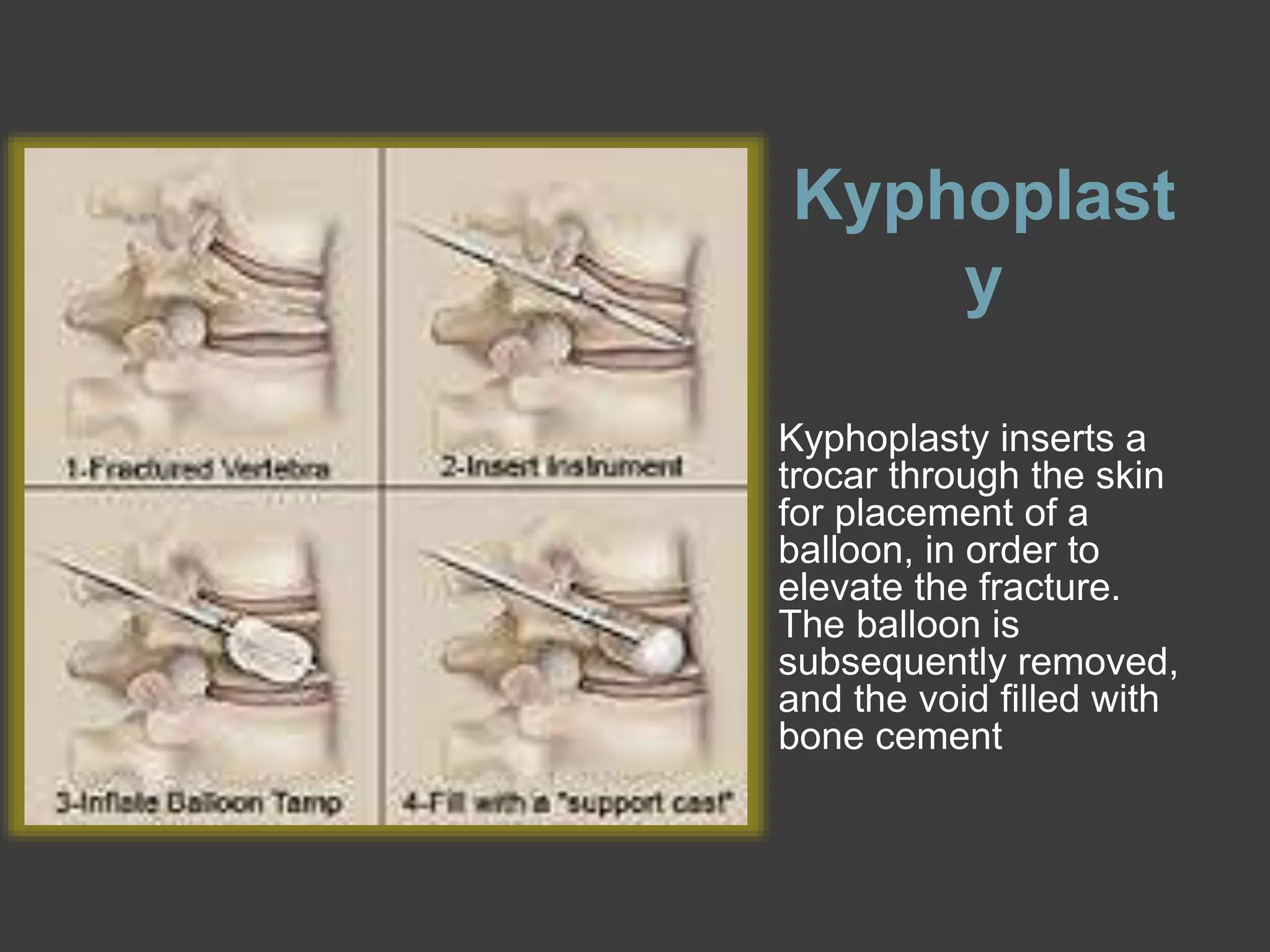 Spinal compression fractures | PPTX