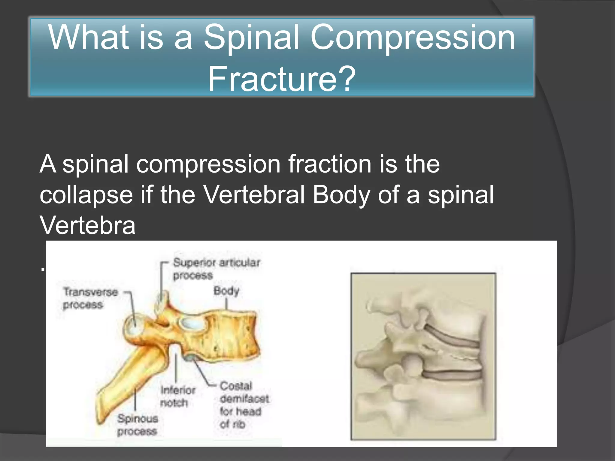 Spinal compression fractures | PPTX