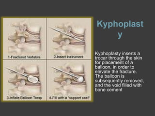 Spinal compression fractures | PPTX