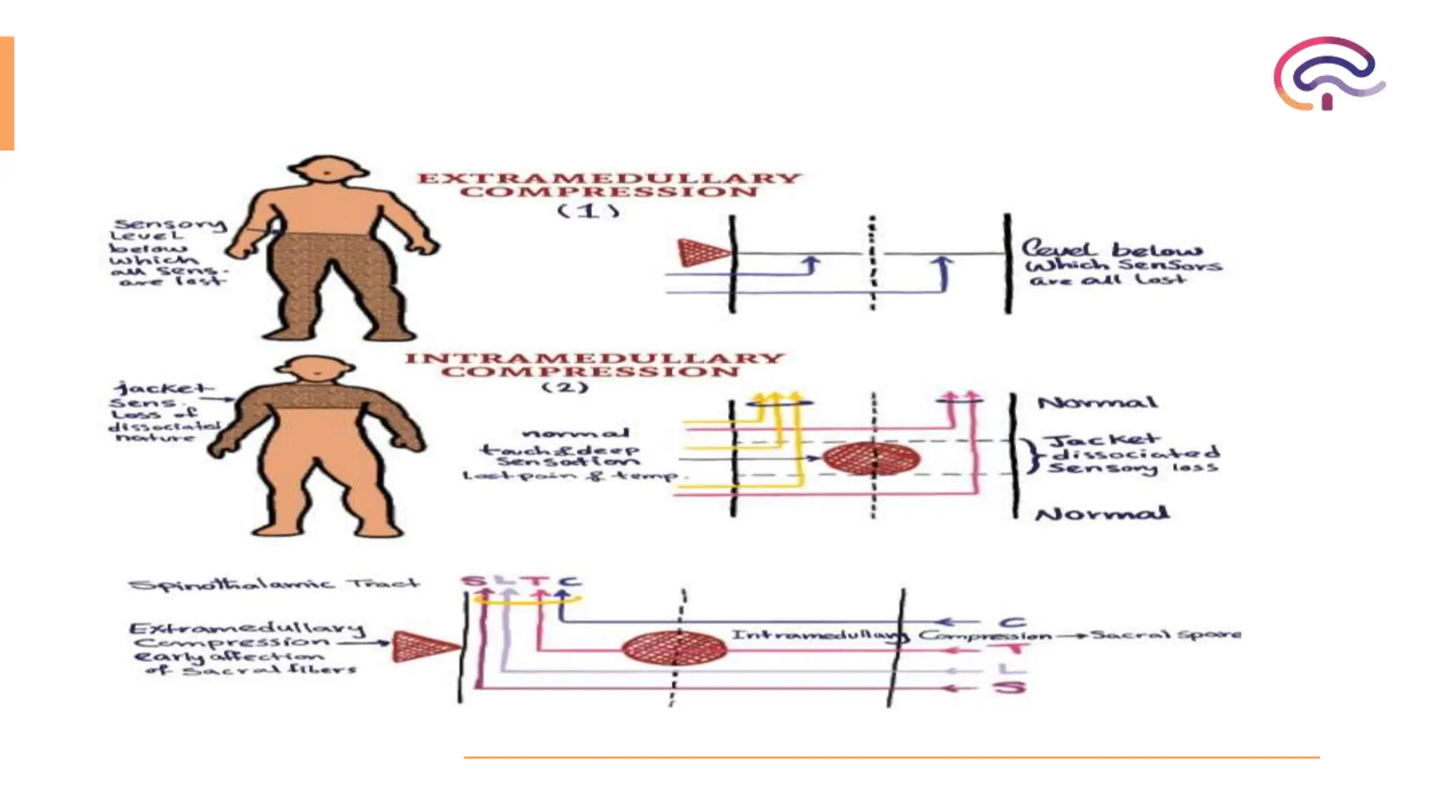 Spinal Cord Disorders And Paraplegia Ppt