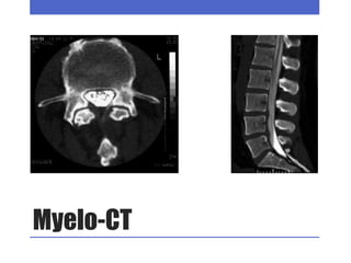 Diseases of Spinal Cord | PPT