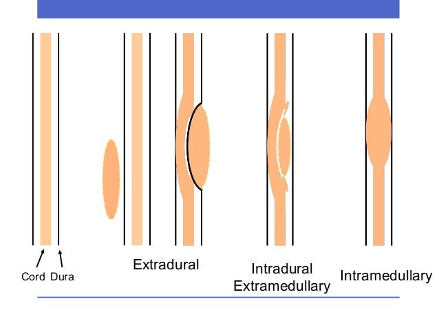 Diseases of Spinal Cord