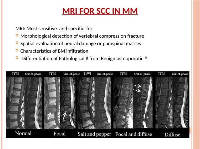 Spinal Cord compression in Multiple Myeloma.pptx
