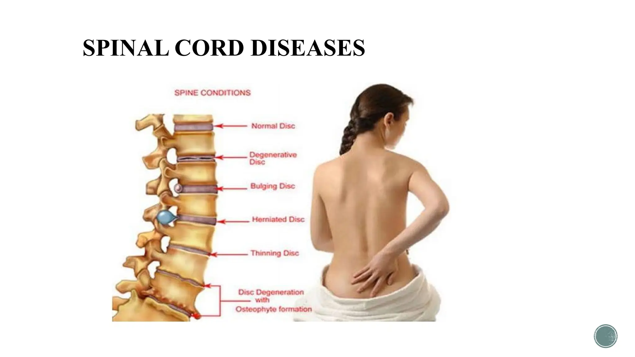 Spinal cord injury ,disease and other chronic lower extremity deformity of bones and spinal ...