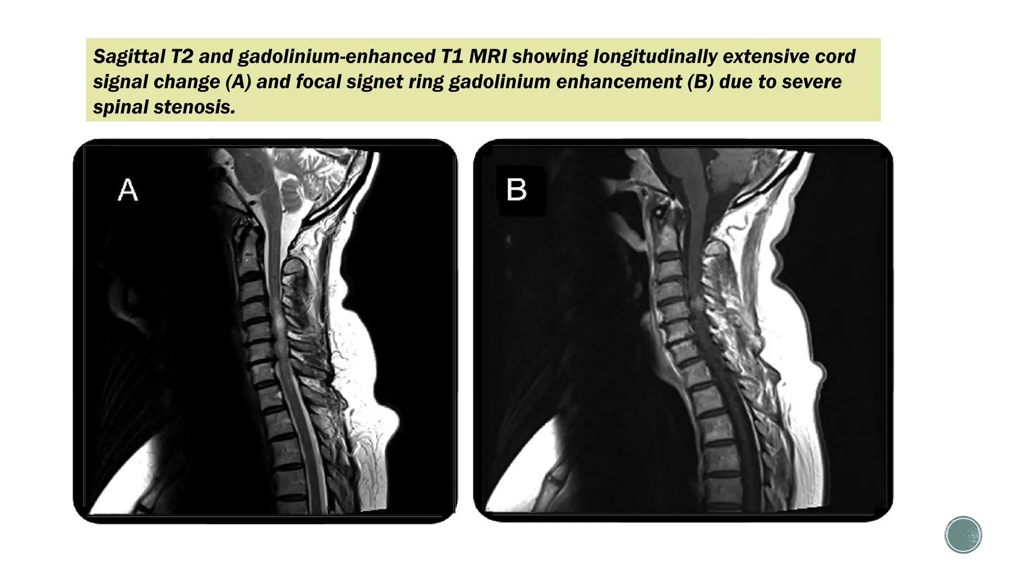 Spinal cord injury ,disease and other chronic lower extremity deformity ...