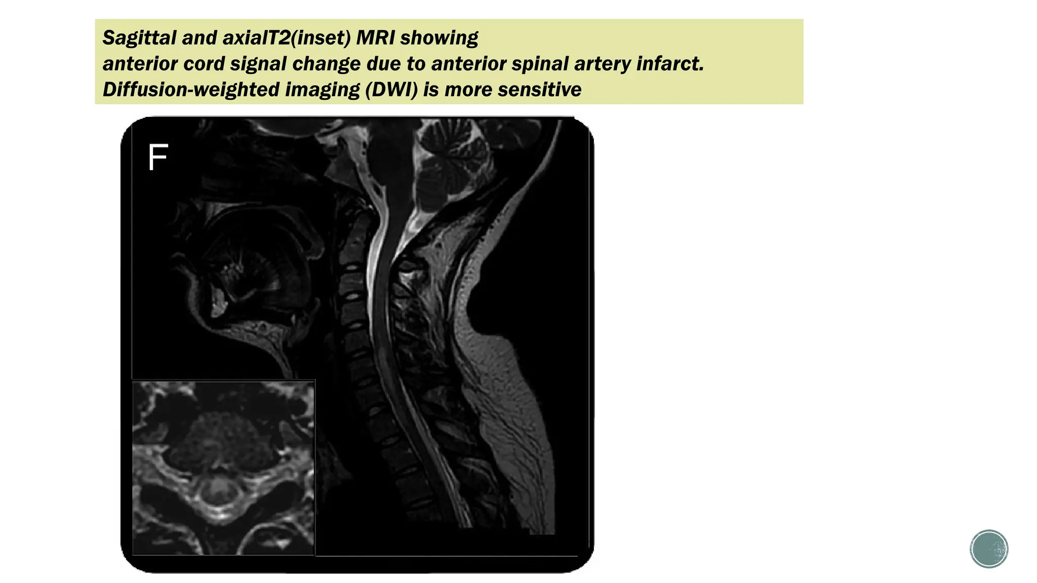 Spinal cord injury ,disease and other chronic lower extremity deformity ...