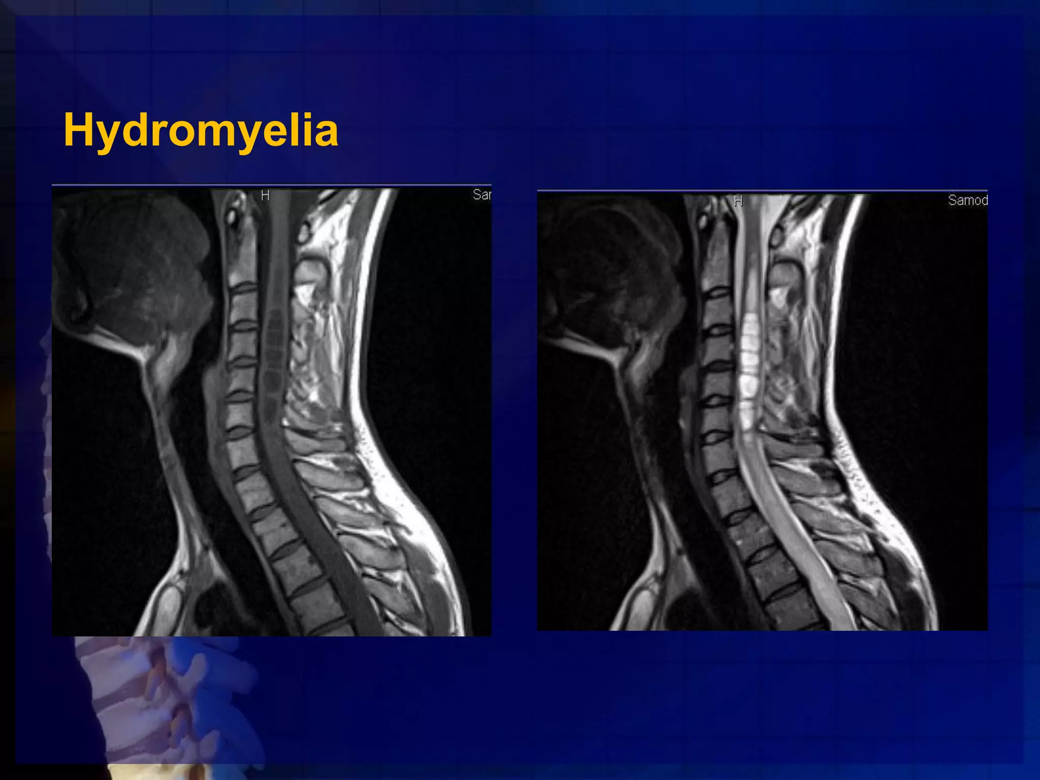 Spinal cord disorders | PPTX