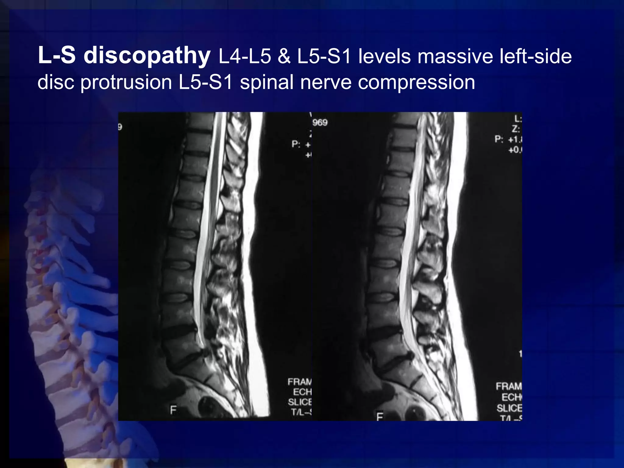 Spinal cord disorders | PPTX