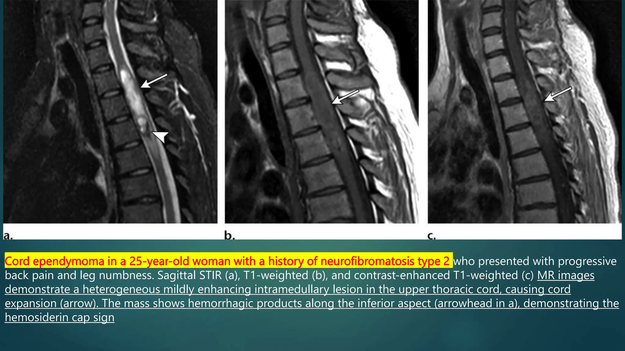SPINAL CORD DISORDERS.pptx