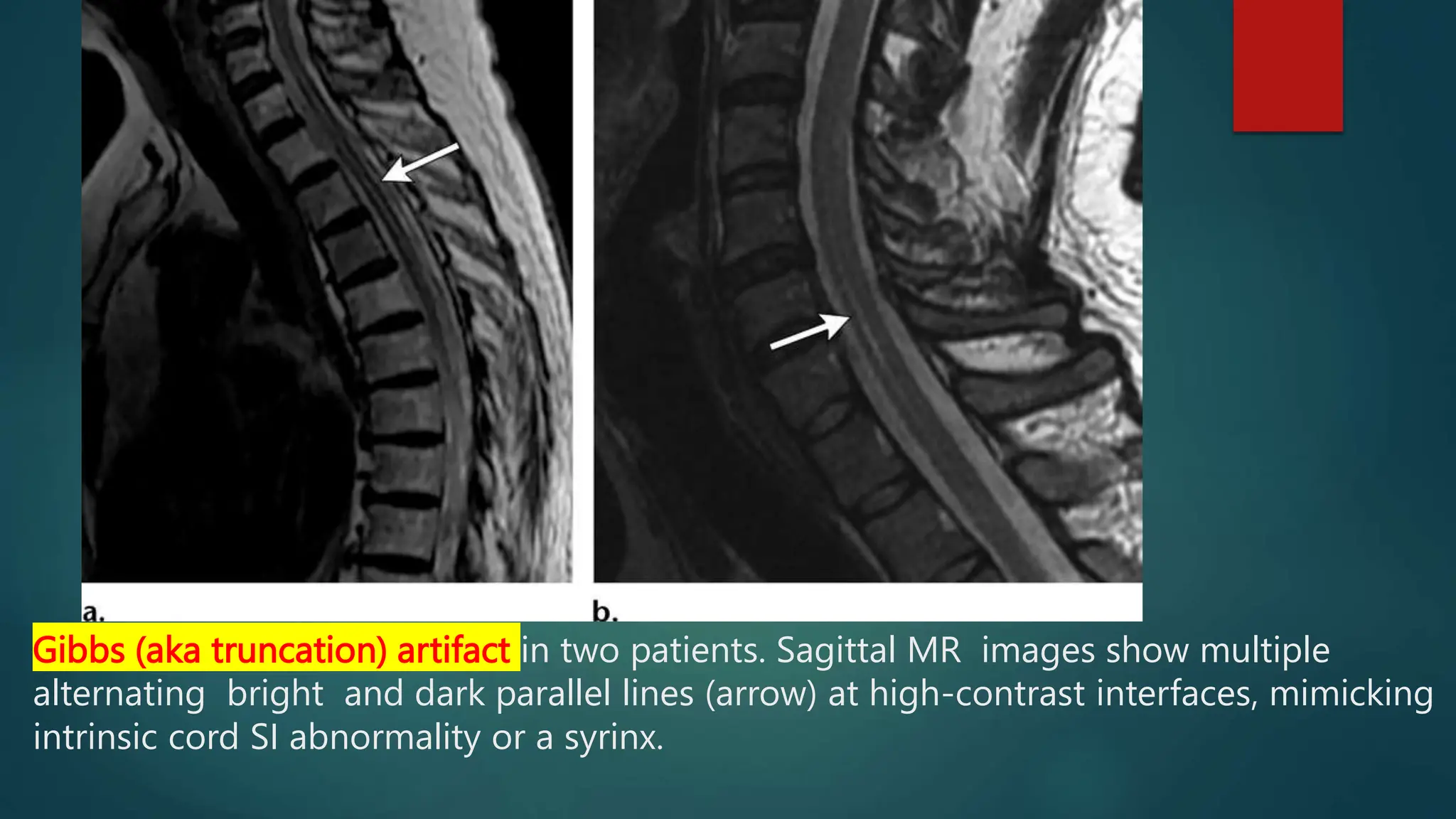 SPINAL CORD DISORDERS.pptx