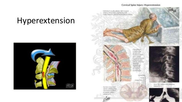 Spinal cord injuries