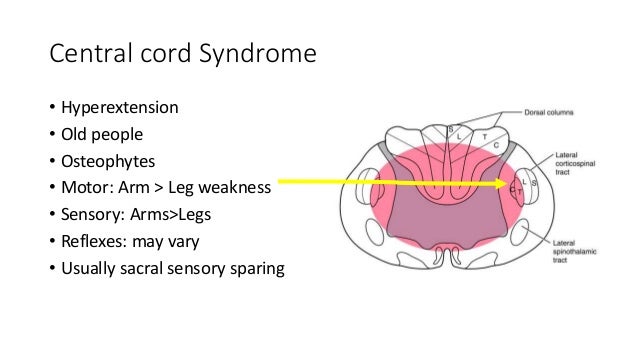 Central Cord Syndrome
