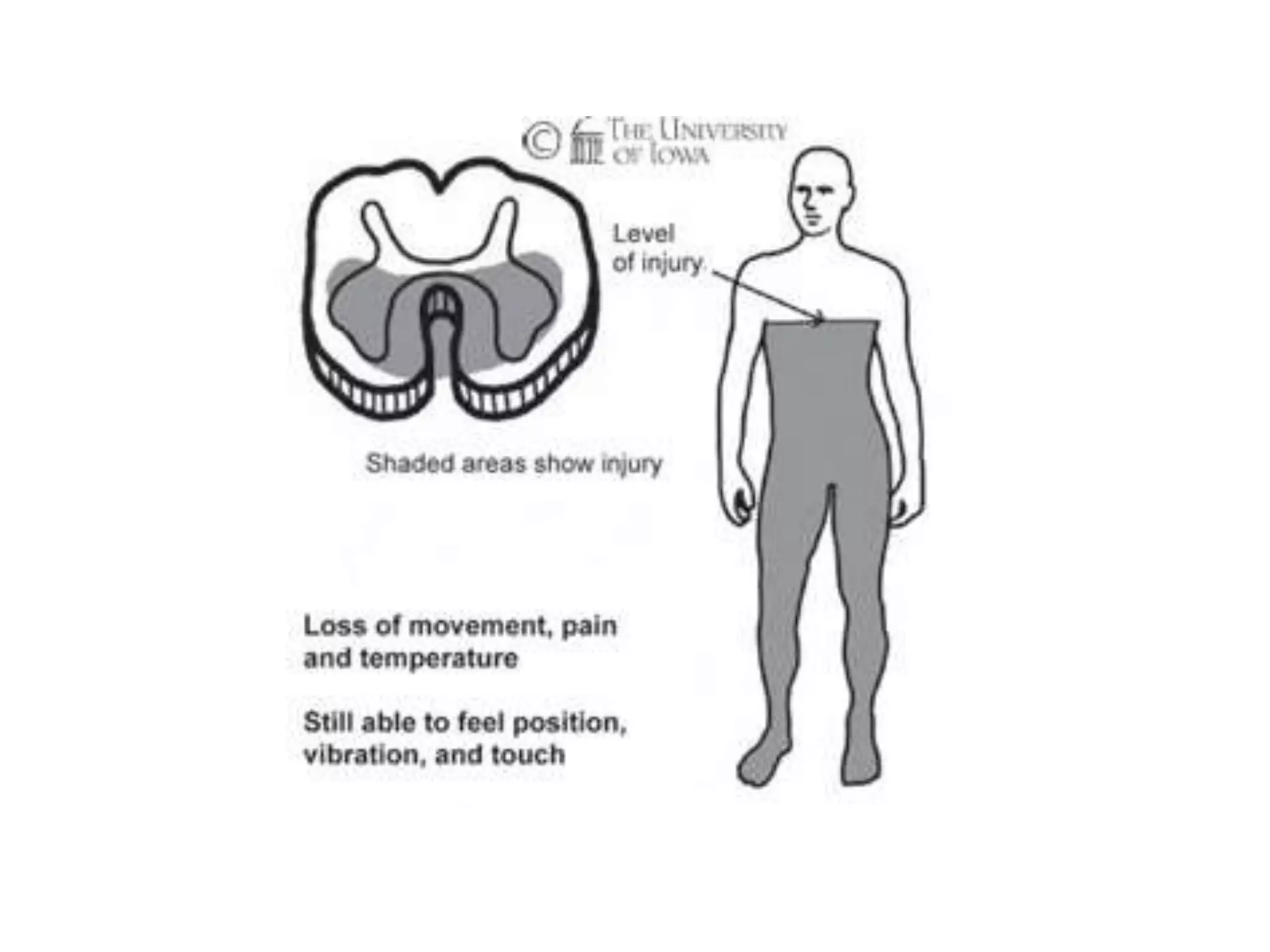 Spinal Cord Injuries Ppt