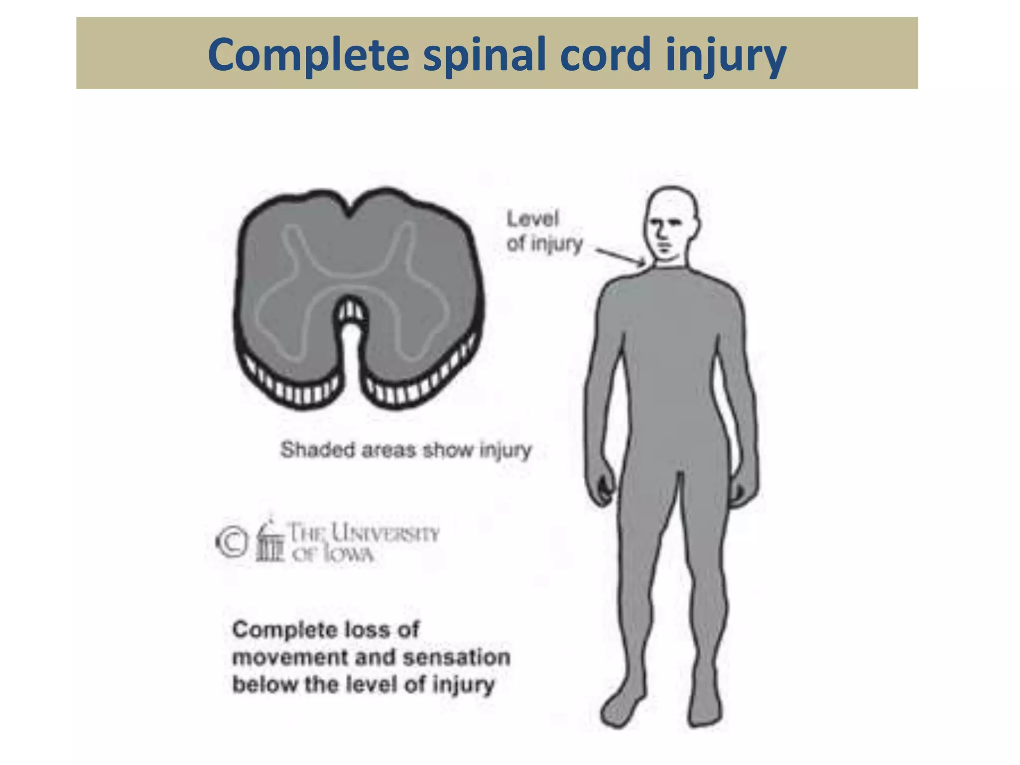 Spinal cord injuries | PPTX