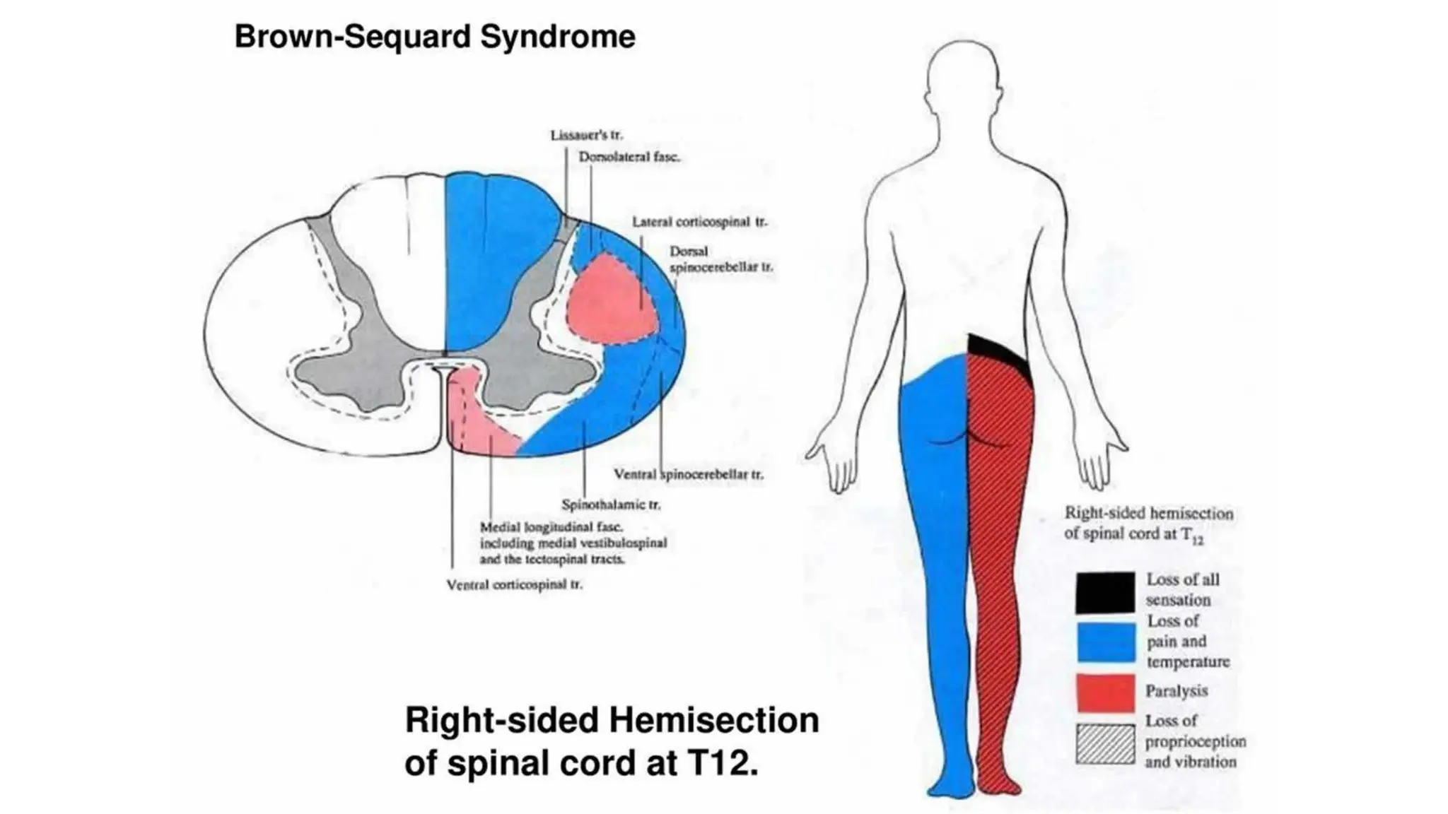 gross anatomy of spinal cord injuries MBBS 2NDYR | PPTX