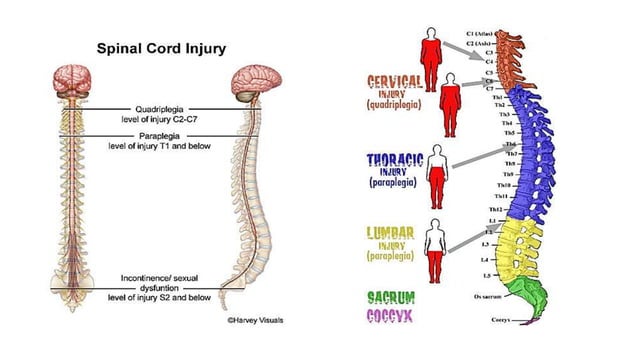 Non Traumatic Spinal cord injuries | PPTX | Death, Injury, or Military ...