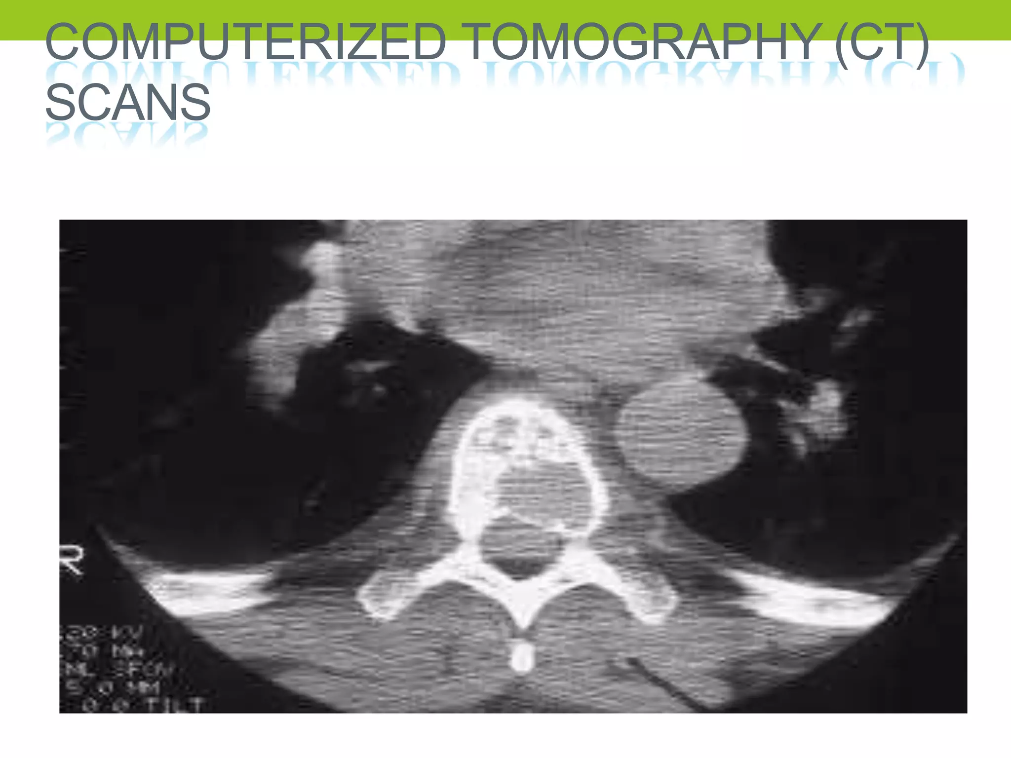 Spinal cord injury (SCI) | PPTX
