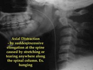 Spinal Cord Injury (SCI) | PPTX
