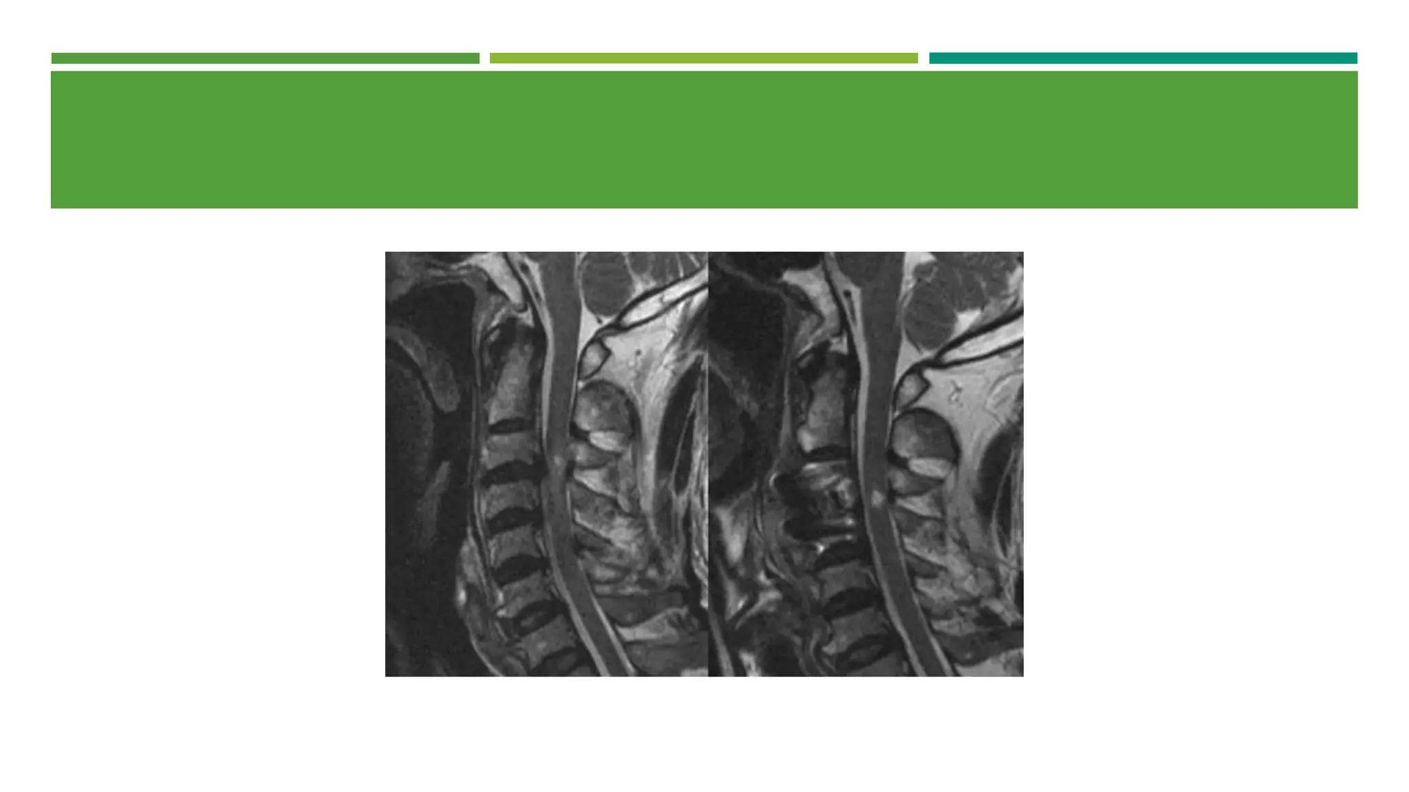 Spinal Cord Injury Without Radiology Abnormality (SCIWORA) | PPTX