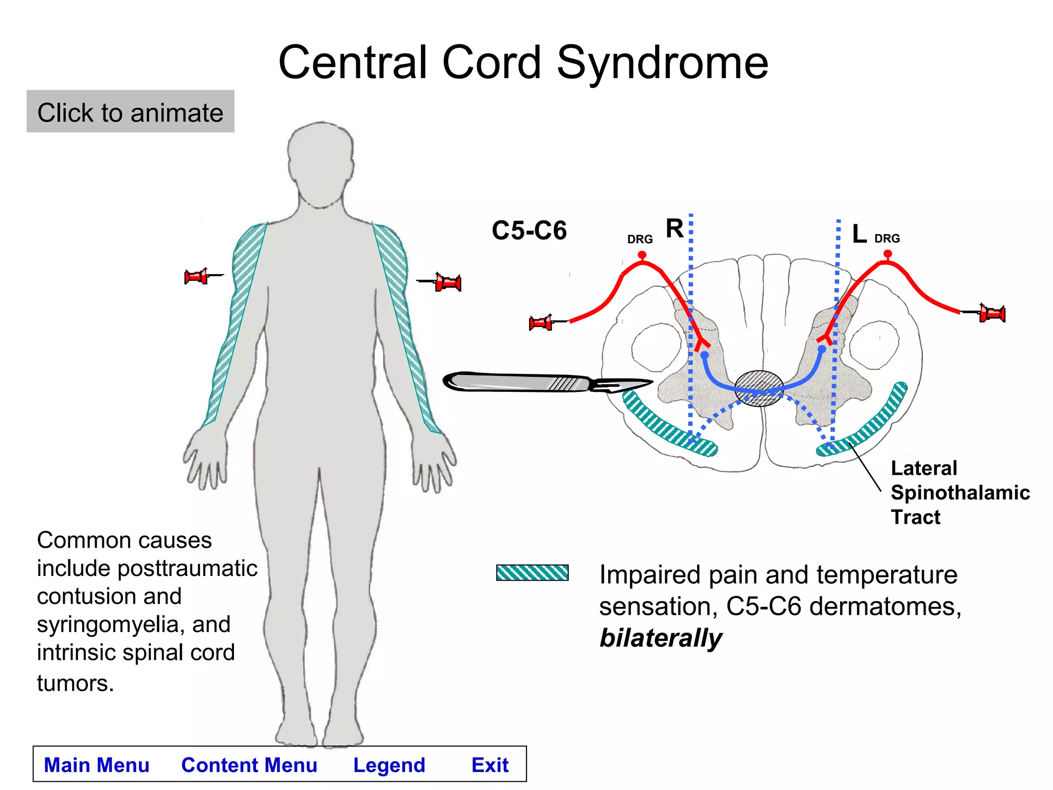 Spinal cord lesions module | PPS