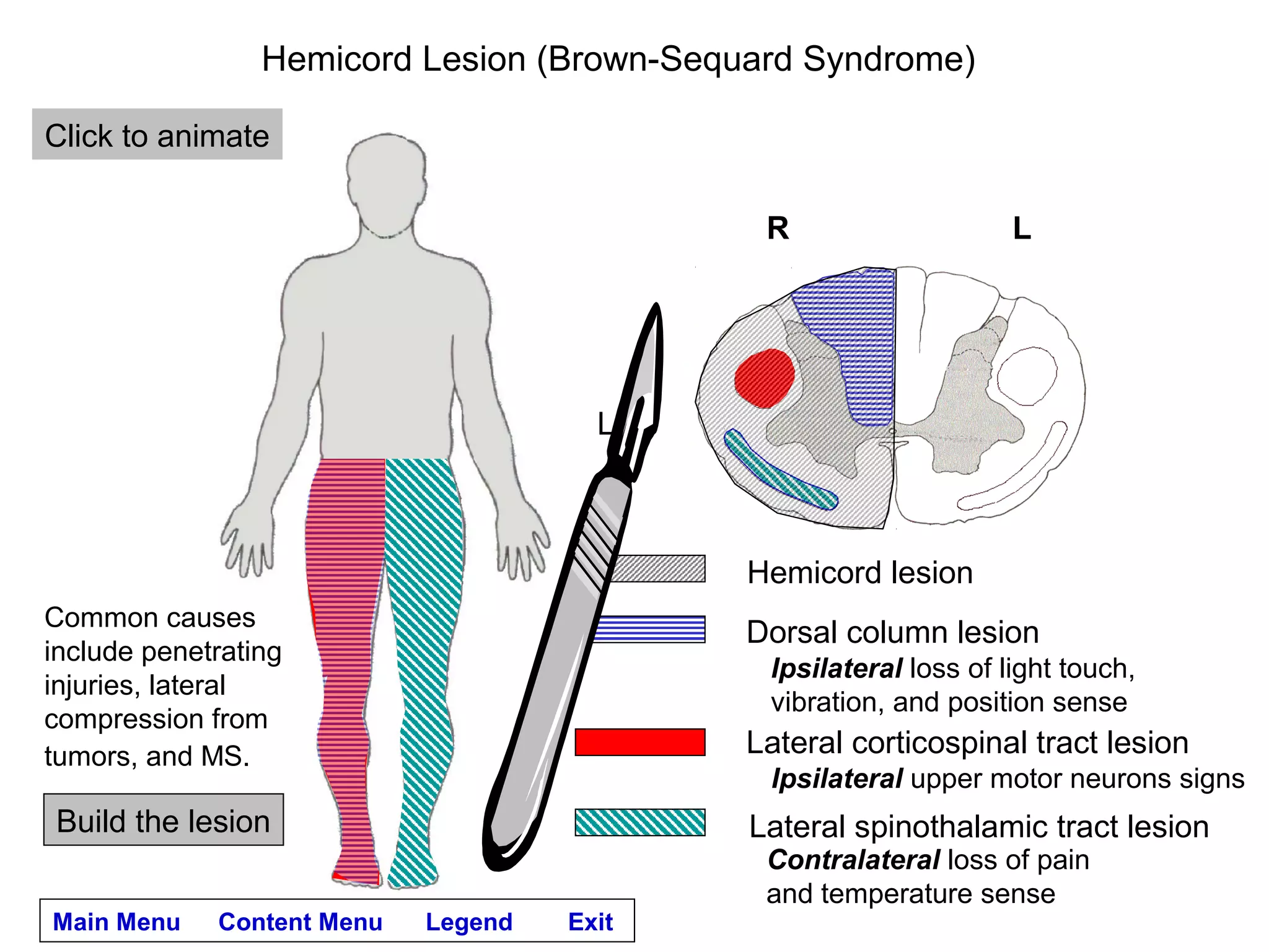 Spinal cord lesions module | PPS