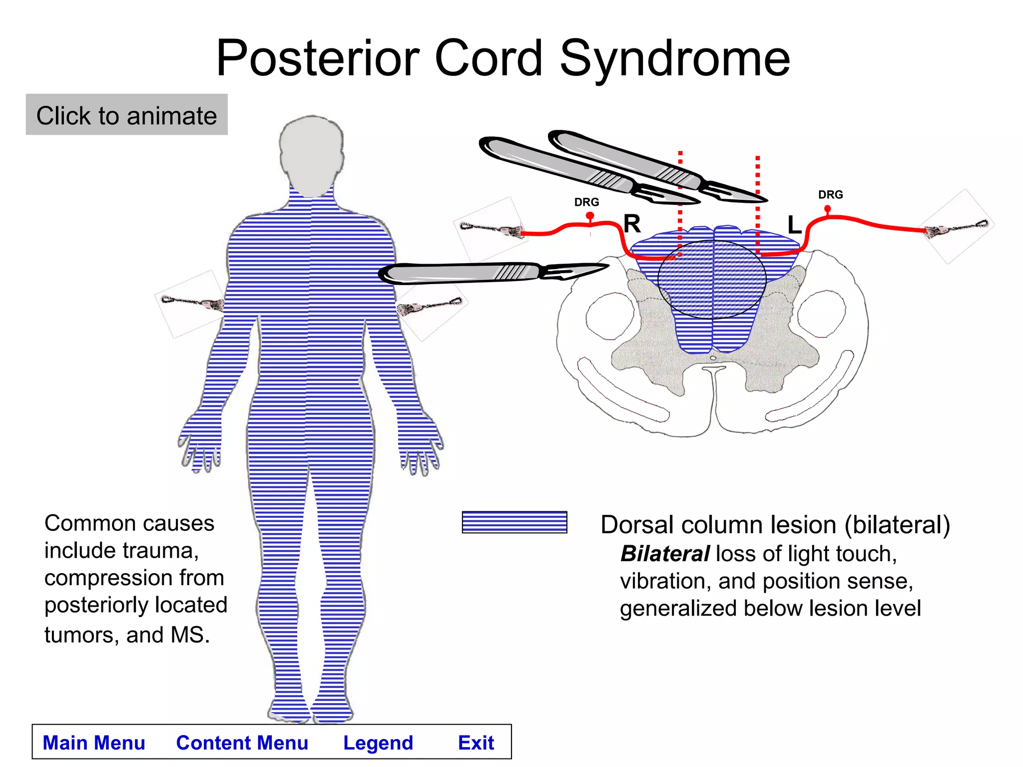Spinal cord lesions module | PPS