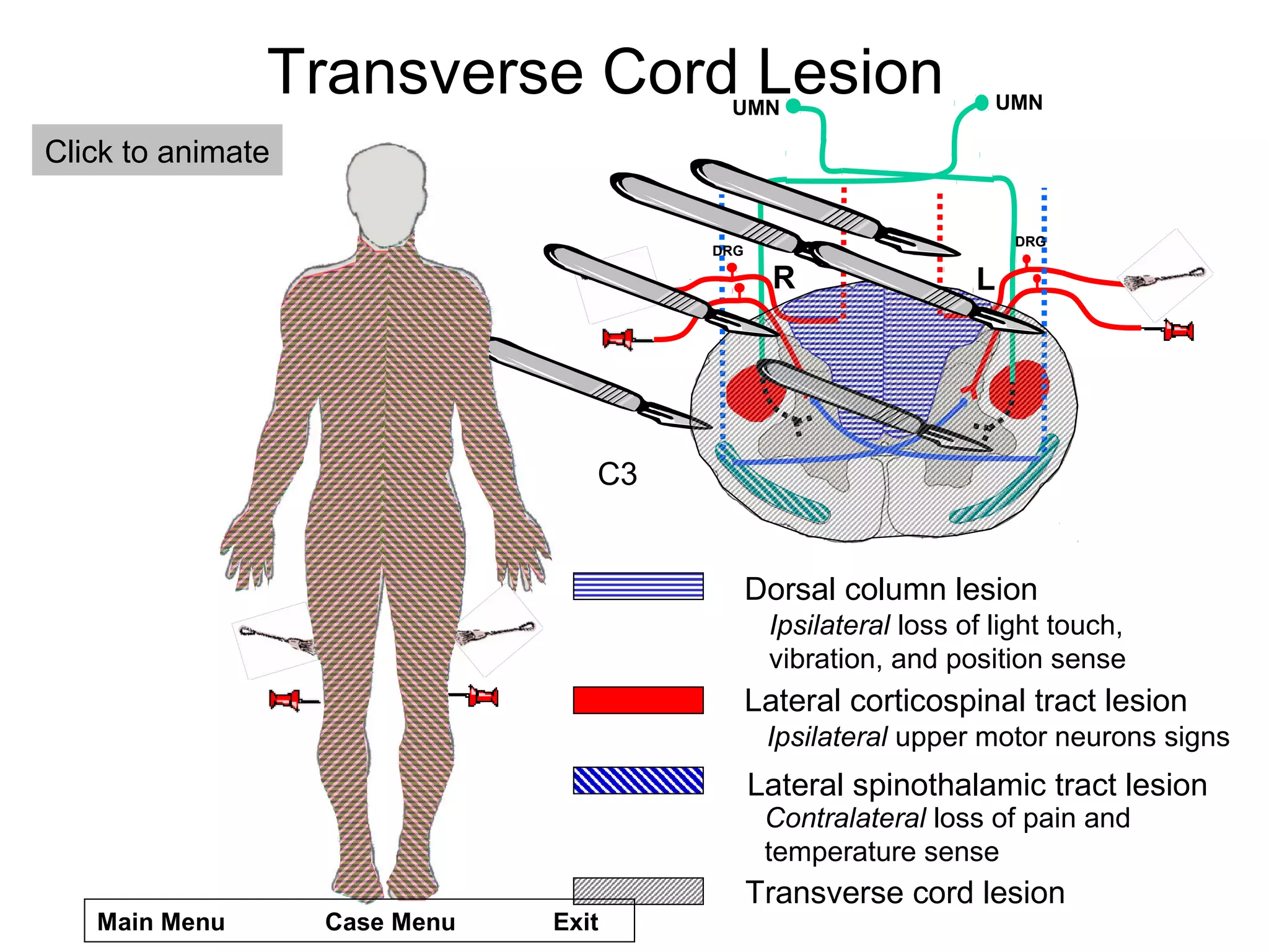 Spinal cord lesions module | PPS