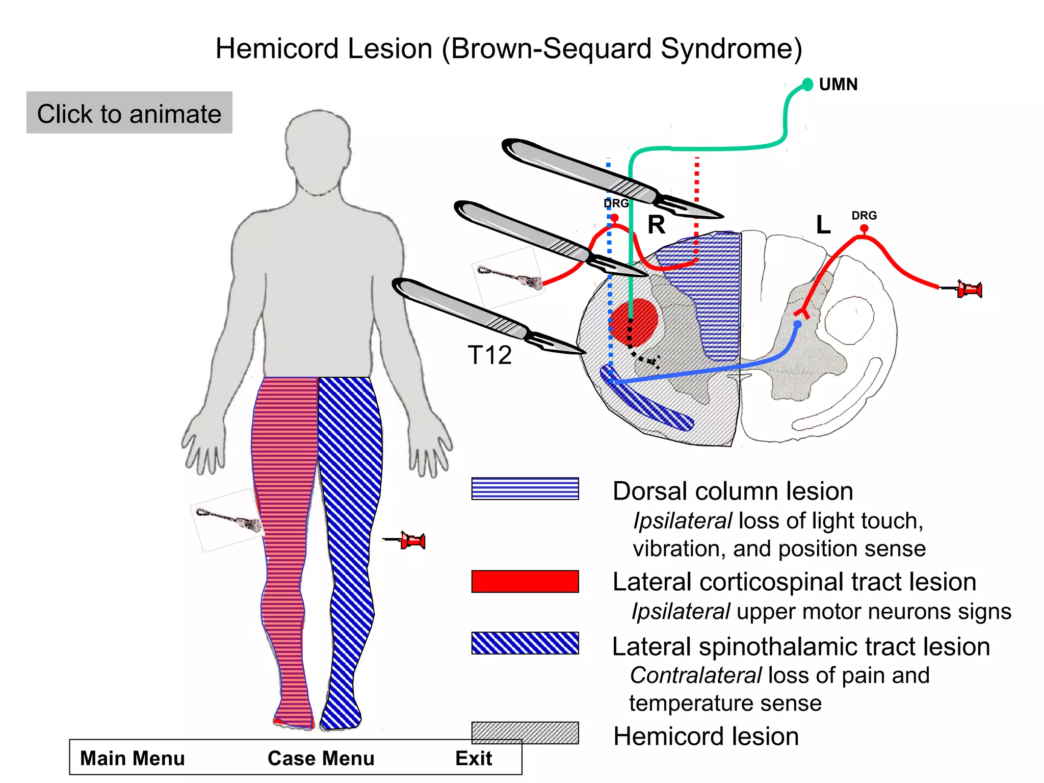 Spinal cord lesions module | PPS