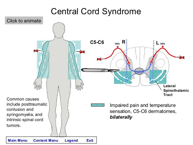 Spinal cord lesions module