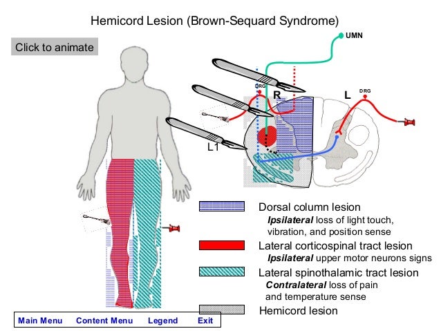 Spinal cord lesions module