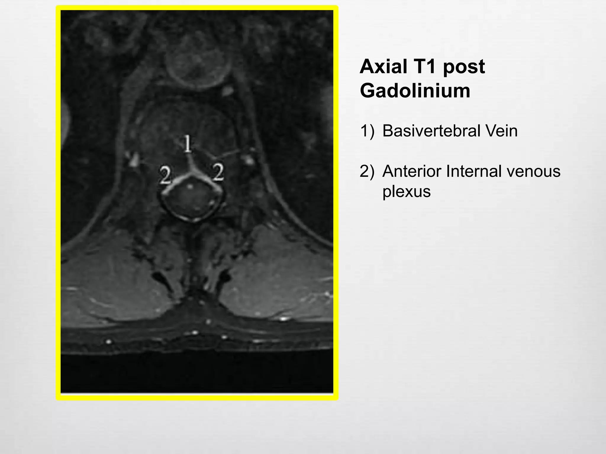 Spinal Cord Magnetic Resonance Angiography - Spinal MRA | PPTX