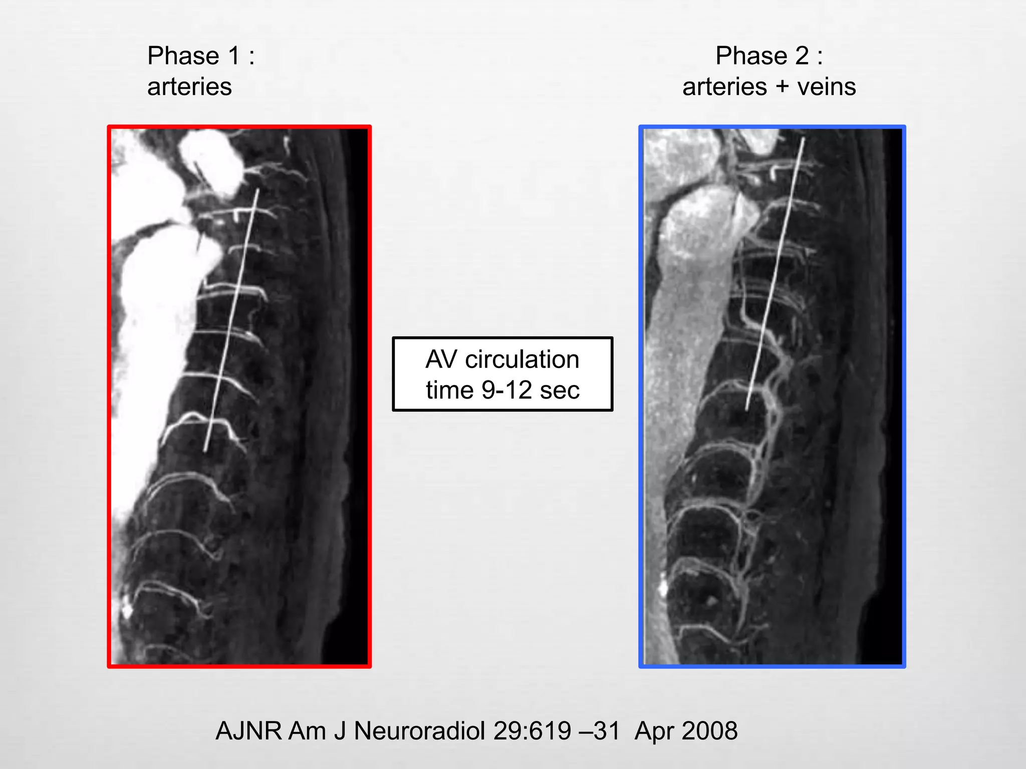 Spinal Cord Magnetic Resonance Angiography - Spinal MRA | PPTX
