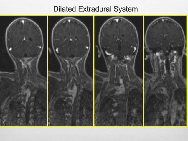 Spinal Cord Magnetic Resonance Angiography - Spinal MRA | PPTX