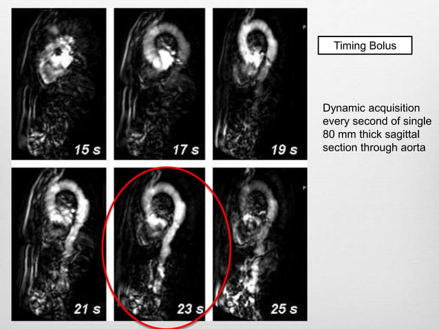 Spinal Cord Magnetic Resonance Angiography - Spinal MRA | PPTX